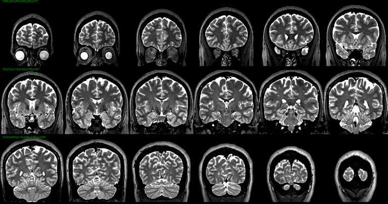 T2 images – McGill Centre for Integrative Neuroscience